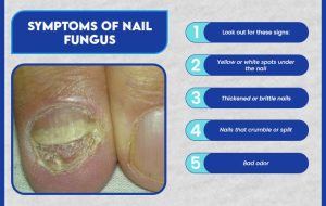 ICD 10 for Onychomycosis | Nail Fungus Diagnosis Code Guide